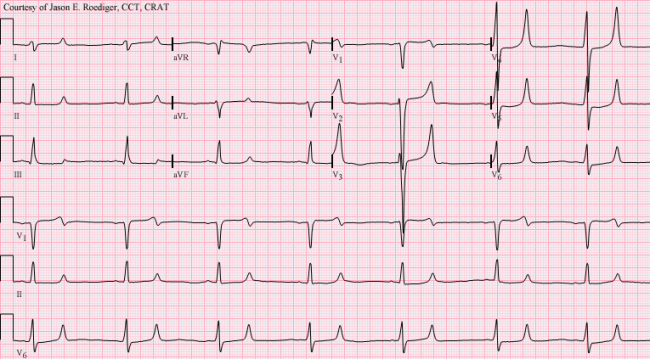 Hypertension | ECG Guru - Instructor Resources Hypertension | ECG Guru - Instructor Resources